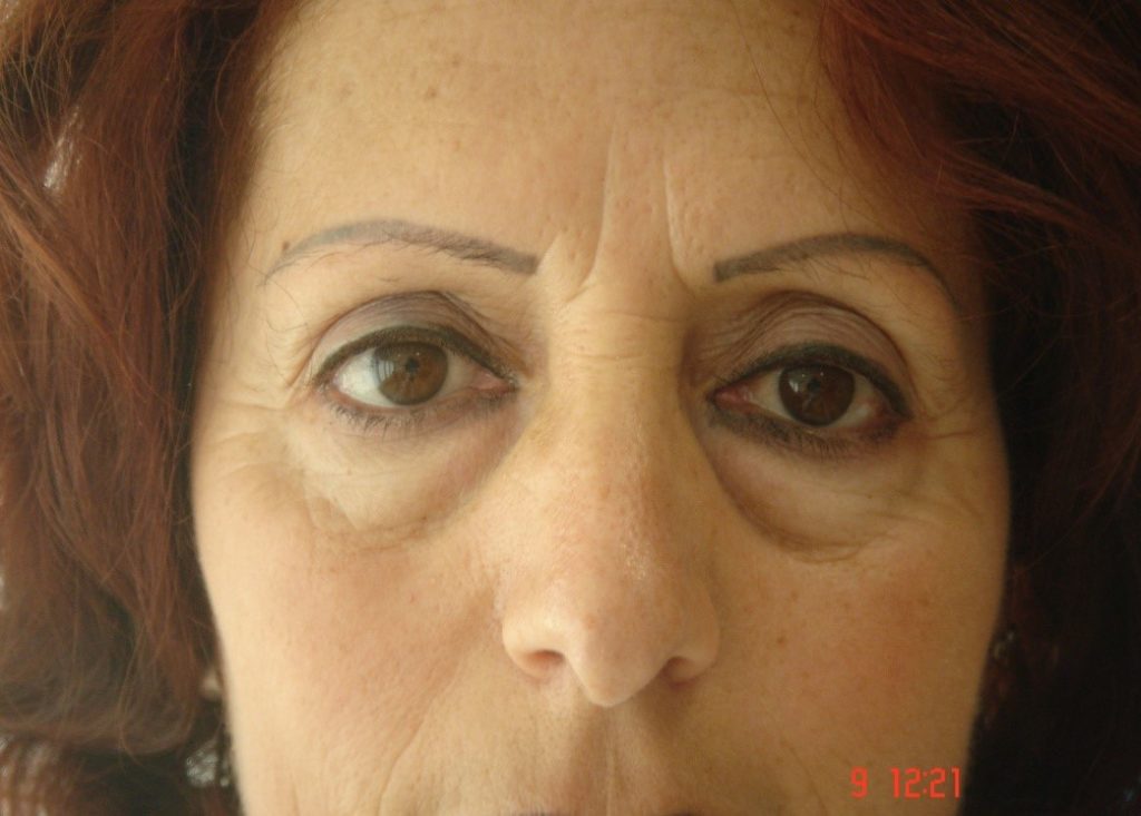 Augenringe: Was tun? | Dr. Linde Blog