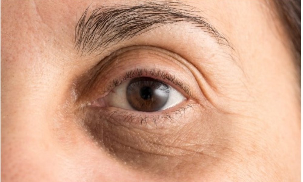 Augenringe – Ursachen & Behandlungsmethoden | BEAUTYCLINIC