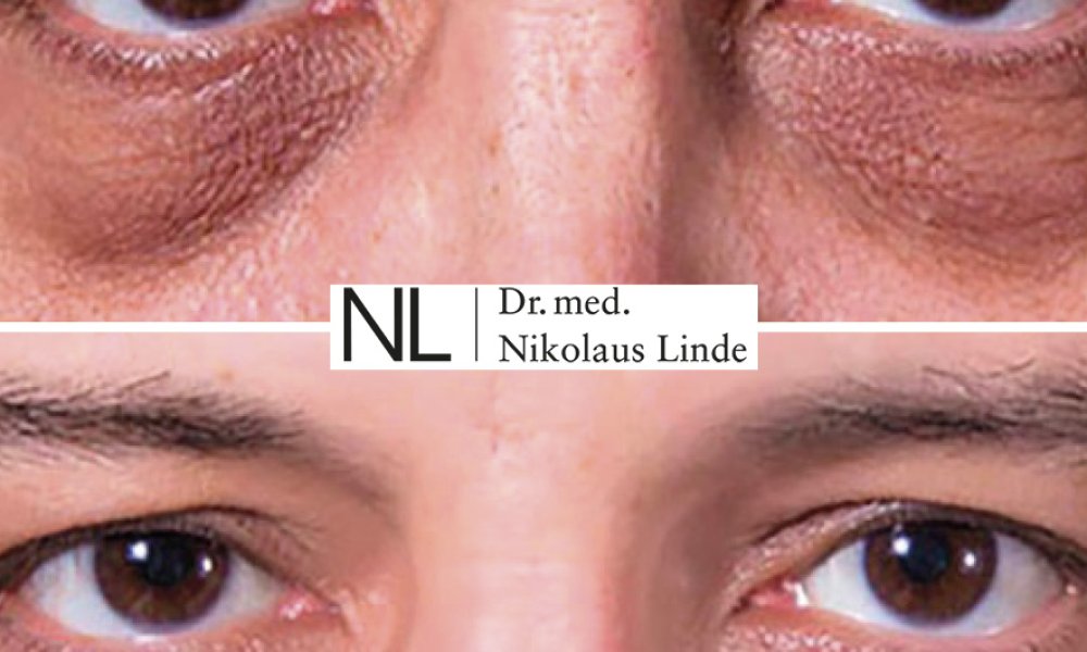 Augenringe | Augenringe | BEAUTYCLINIC