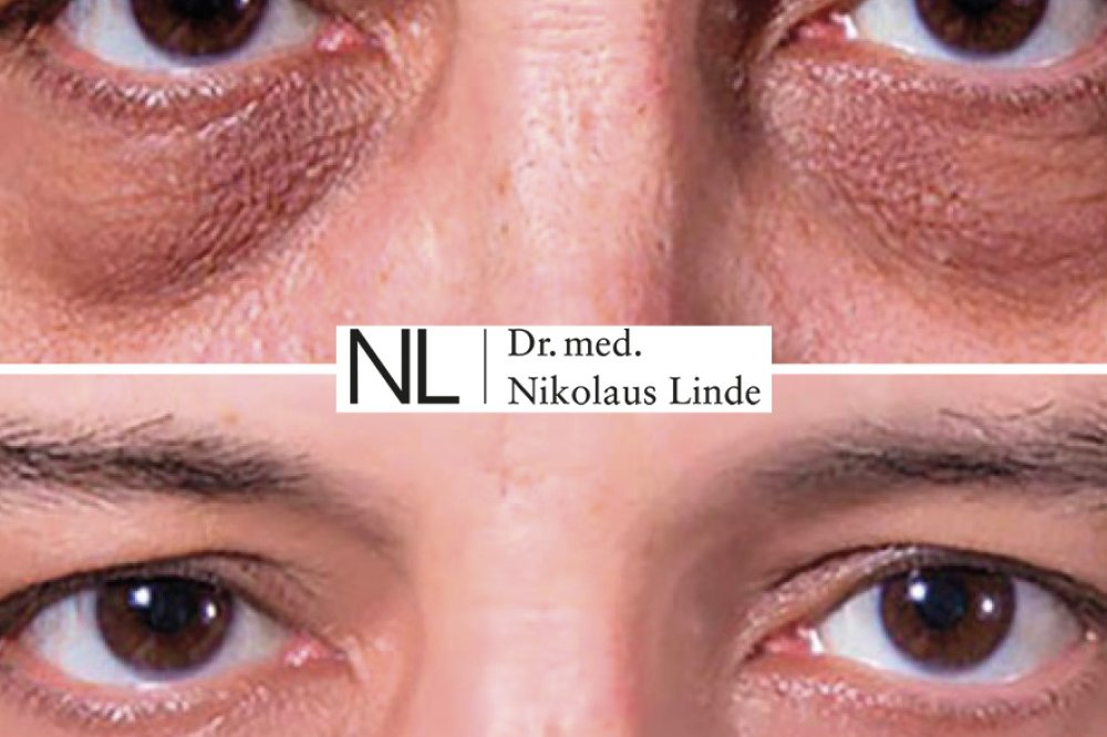 Augenringe | Augenringe | BEAUTYCLINIC