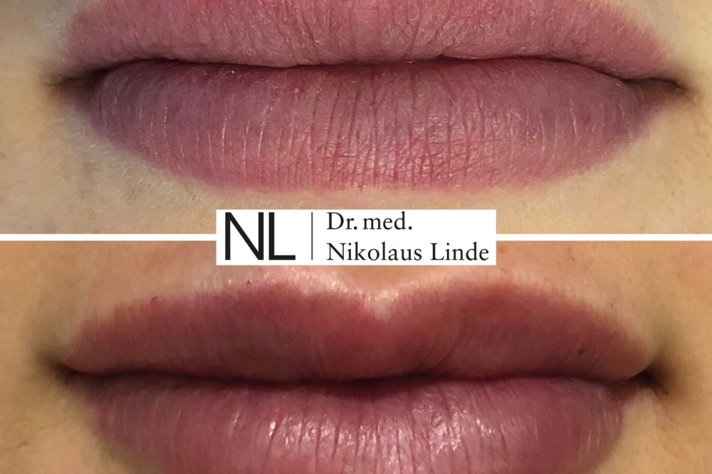 Lippen | vorher / nachher Bilder
